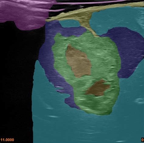 Ultrasound Segmentation Of Ius Images The Top Row Shows Suboptimal Us Download Scientific