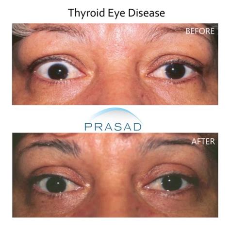 Thyroid Eye Disease How To Fix Retracted Eyelids And Restore Comfort