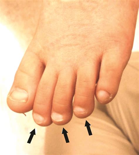 The Pediatric Infectious Disease Journal