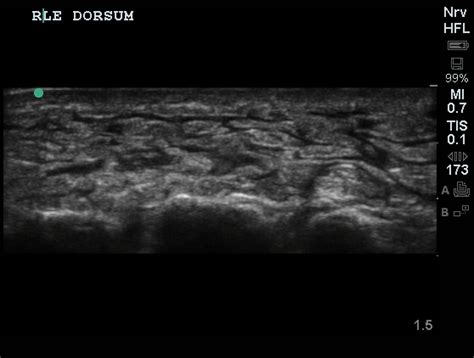 Cellulitis Tags Differential Diagnosis Of