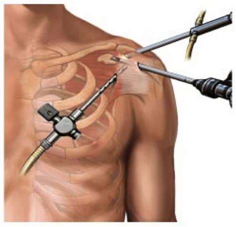 Shoulder Arthroscopic Surgery At ₹ 80000pieces In Ahmedabad Id