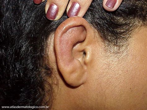 Relapsing Polychondritis Nc Commons
