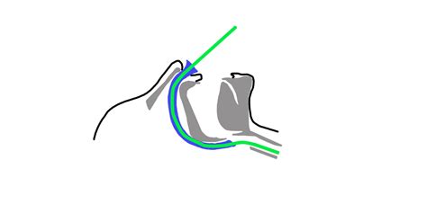 Using Video Laryngoscopy For Nasal Intubation The Airway Jedi