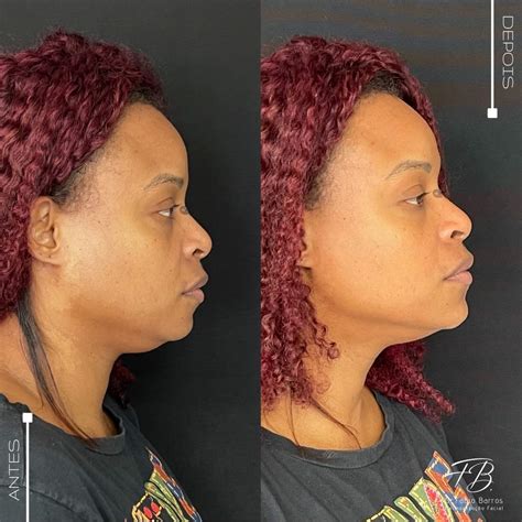 Projeção de Mento Harmonização Facial Dr Fabio Barros Rio de