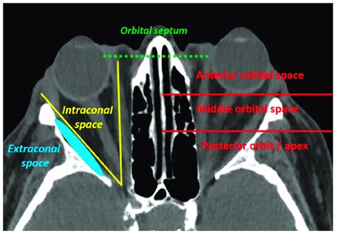 Orbital Septum Anatomy