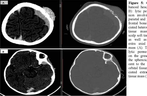 Figure 5 From Ewing Sarcoma With Unusual Skull Metastasis In A Four
