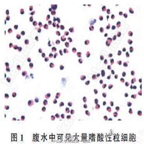 嗜酸粒细胞胃肠炎伴腹水1例 医联