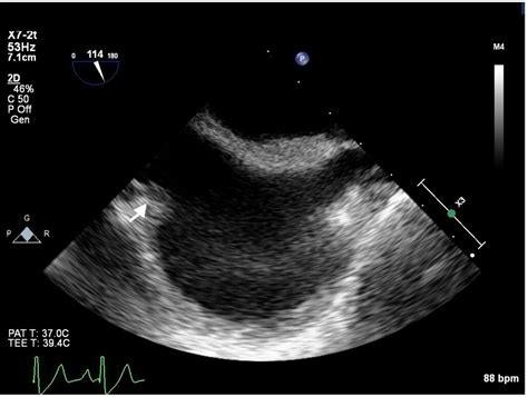 Prominent Eustachian Valve