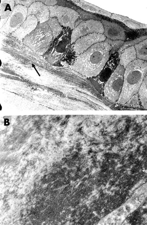 Thiel Behnke Dystrophy