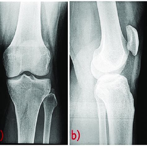 Radiograph Of The Left Knee In Anteroposterior And Lateral View At