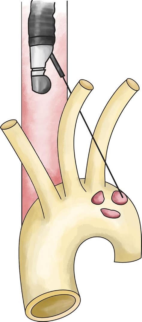 New Technique Performed By Using Eus Access For Biopsy Of Para Aortic