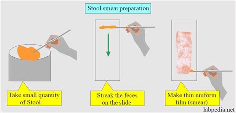 Stool Examination Part 1 Stool Examination Findings Labpedia By