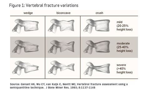 Types Of Lumbar Fractures Design Talk