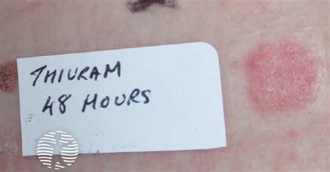 Positive Patch Test To Thiuram Image