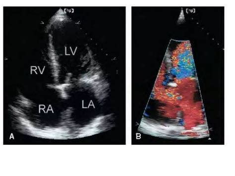Asd Echo Assessment Pptx