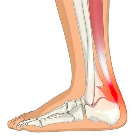 Achilles Tendon Rupture Dr Osama Samir Al Droubi