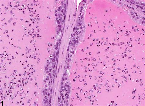 Coagulating Gland Inflammation Nonneoplastic Lesion Atlas