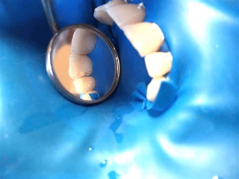 Class Iii Cavity On A Central Upper Incisor Initial Moment Value Download Scientific