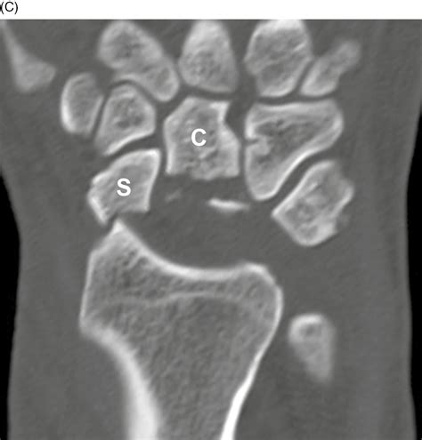Scaphoid And Lunate Fossa