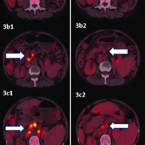 Fluorodeoxyglucose Positron Emission Tomographycomputed Tomography