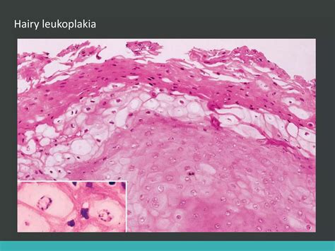White Lesions Of Oral Cavity Pptx