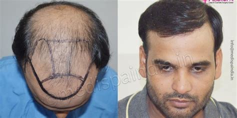 Best Hair Transplant Clinics In Ahmedabad