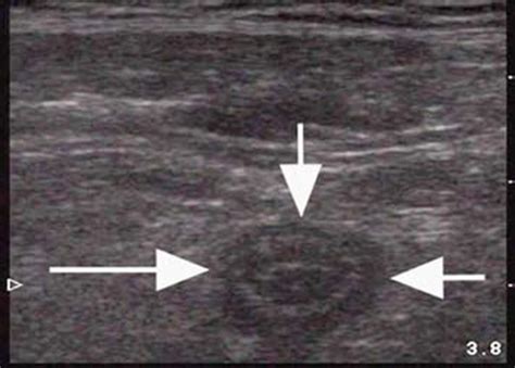 Inflamed Appendix In Short Axis View Download Scientific Diagram