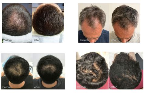 The Science Behind Hair Loss Understanding The Root Causes And