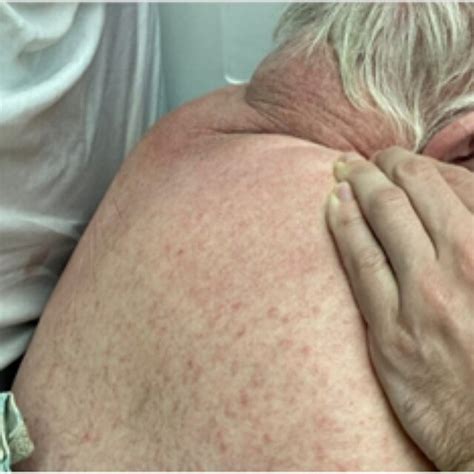 Diffuse Maculopapular Rash Involving The Upper Back Download
