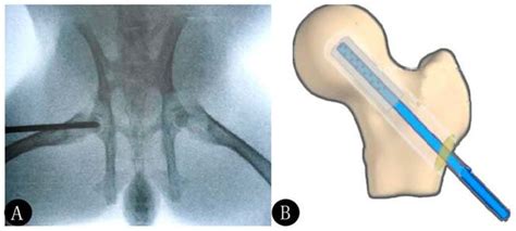 Core Decompression Surgery An X Ray Scan Ensured The Depth Of