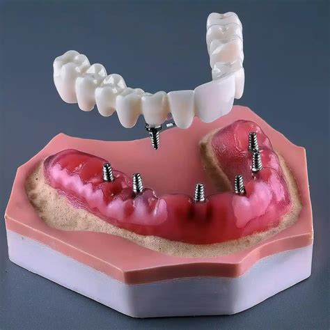 Mini Dental Implants Vs Traditional Implants
