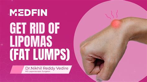 Lipoma Treatment Diagnosis Necessity And Procedure Explained Youtube