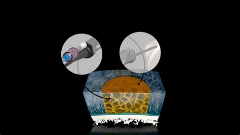 Arthrex Autocart™ Procedure For Symptomatic Cartilage Defects