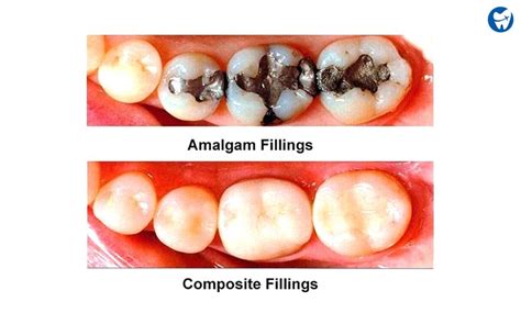How Much Do Dental Fillings Cost Peridot Dental Care