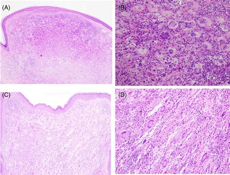 Juvenile Xanthogranuloma Histology Juvenile Xanthogranuloma Histology