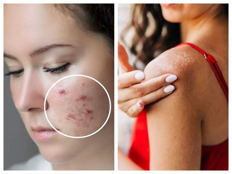 This One Food Can Fix Sunburn Sun Tan And Summer Blisters Read On