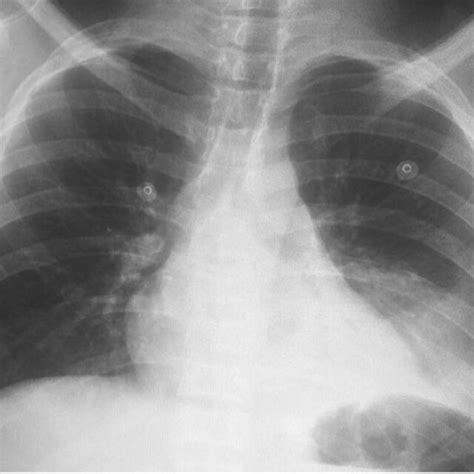 Chest X Ray Demonstrate Left Lower Lobe Opacification With Minimal