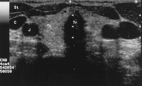 Sonographic Anatomy Of The Thyroid Gland Note Thyroid Th Trachea Download Scientific