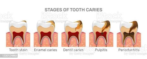 현실적인 스타일의 치아 충치 구조와 전체 배치 단계 얼룩 에나멜 충치 치과 Pulpitis 치주염 진기바 벡터 그림 3d 이빨에 대한 스톡 벡터 아트 및 기타 이미지
