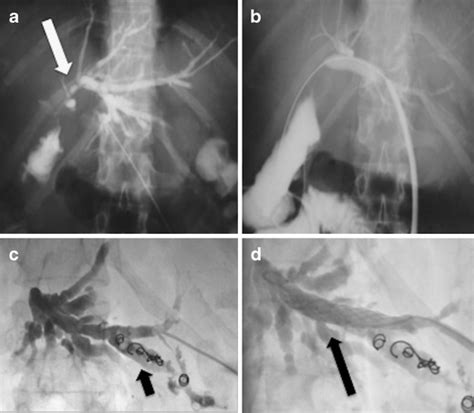 A Patient With Intra Hepatic Stenosis And Bile Leak Post Biliodigestive Download Scientific