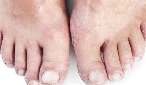 Trattamento Dei Funghi Tra Le Dita Dei Piedi Con Rimedi Popolari