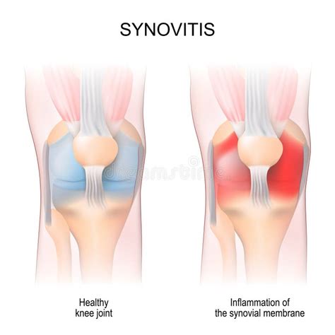 Synovitis Human Knee Joint Anatomy Stock Vector Illustration Of
