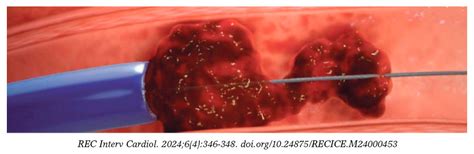 Practical Concepts Of Catheter Directed Aspiration Thrombectomy In Ecmo