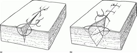 Suture Simple Interrupted Sutures Surgical Removal Figure Sizes Times