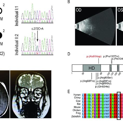 Summary Of Genetic And Clinical Features Of Microphthalmiaanophthalmia
