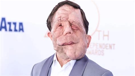 Adam Pearson Blasts Comedians ‘character After He Makes Fun Of His
