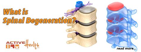 A Chiropractic Look At Spinal Degeneration Chiropractor Park Ridge