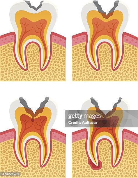 Dental Caries Stages Fotografías E Imágenes De Stock Getty Images