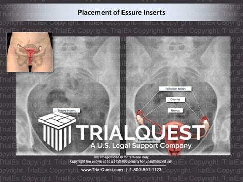 Placement Of Essure Inserts Trial Exhibits Inc