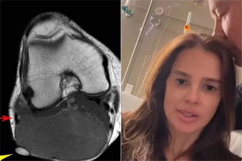 O que é sarcoma sinovial e como é feito o tratamento Doença atinge